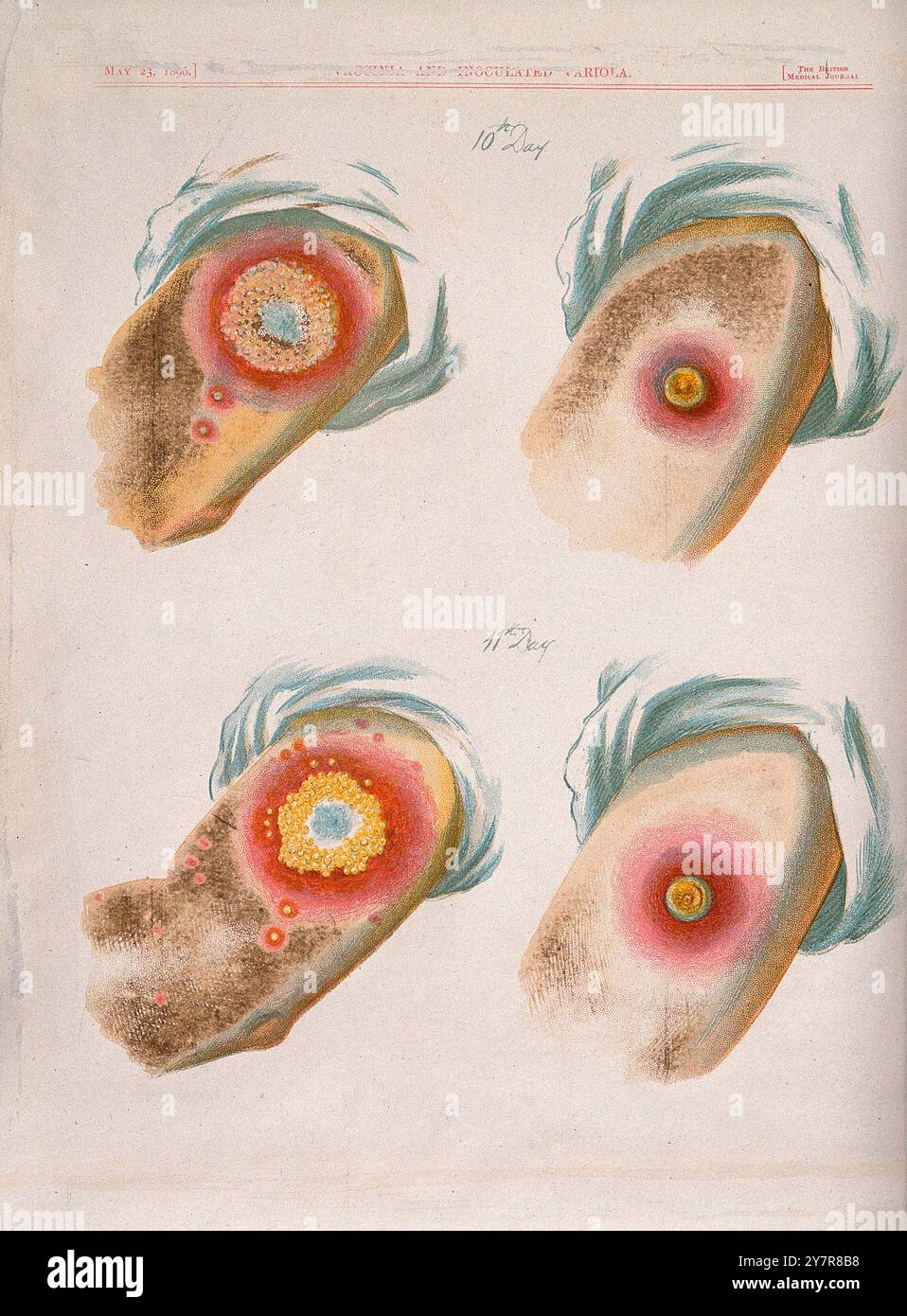 Vintage illustration of a comparison between smallpox and cowpox ...