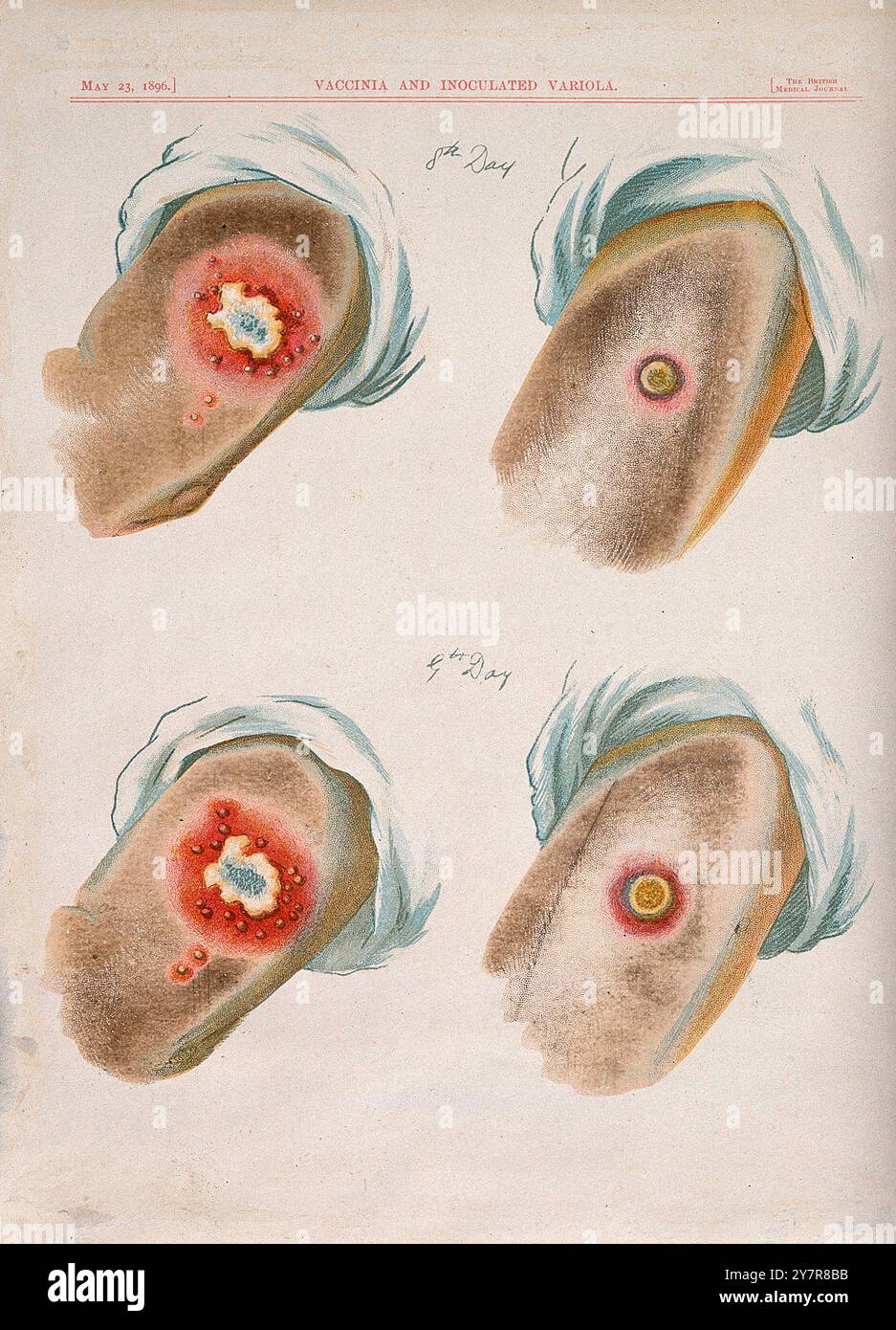 Vintage illustration of a comparison between smallpox and cowpox ...