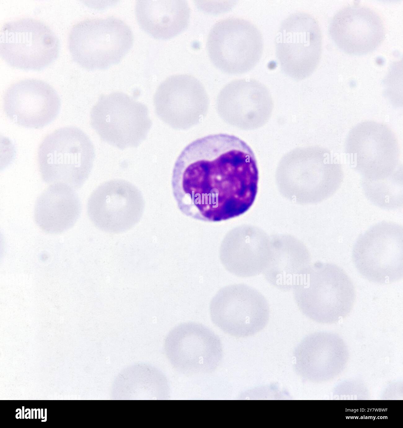 Photomicrograph Malaria in human blood cells (Plasmodium fulciparum ...