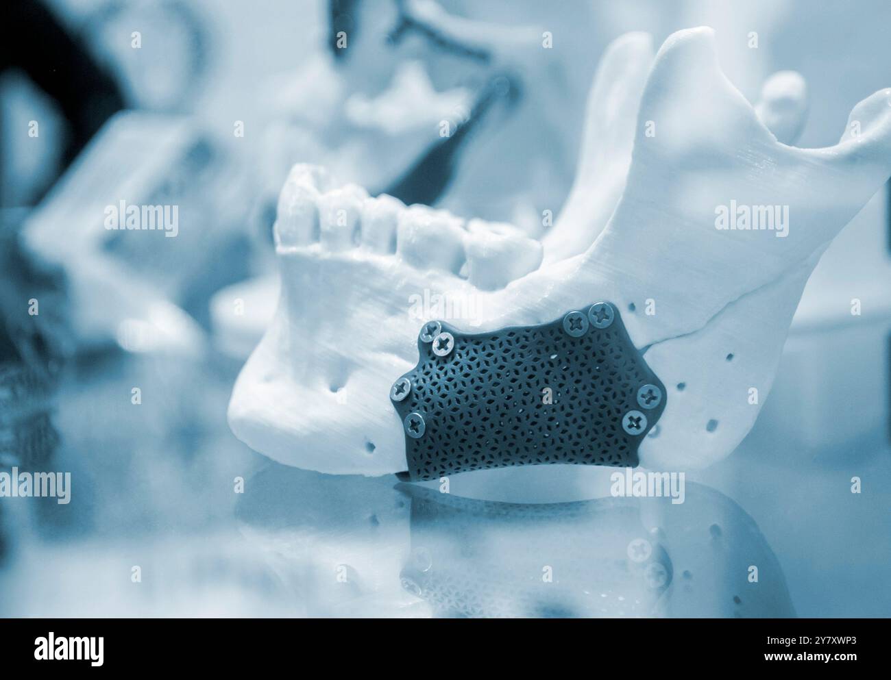 Prototype of lower human jaw with medical titanium implant from ...