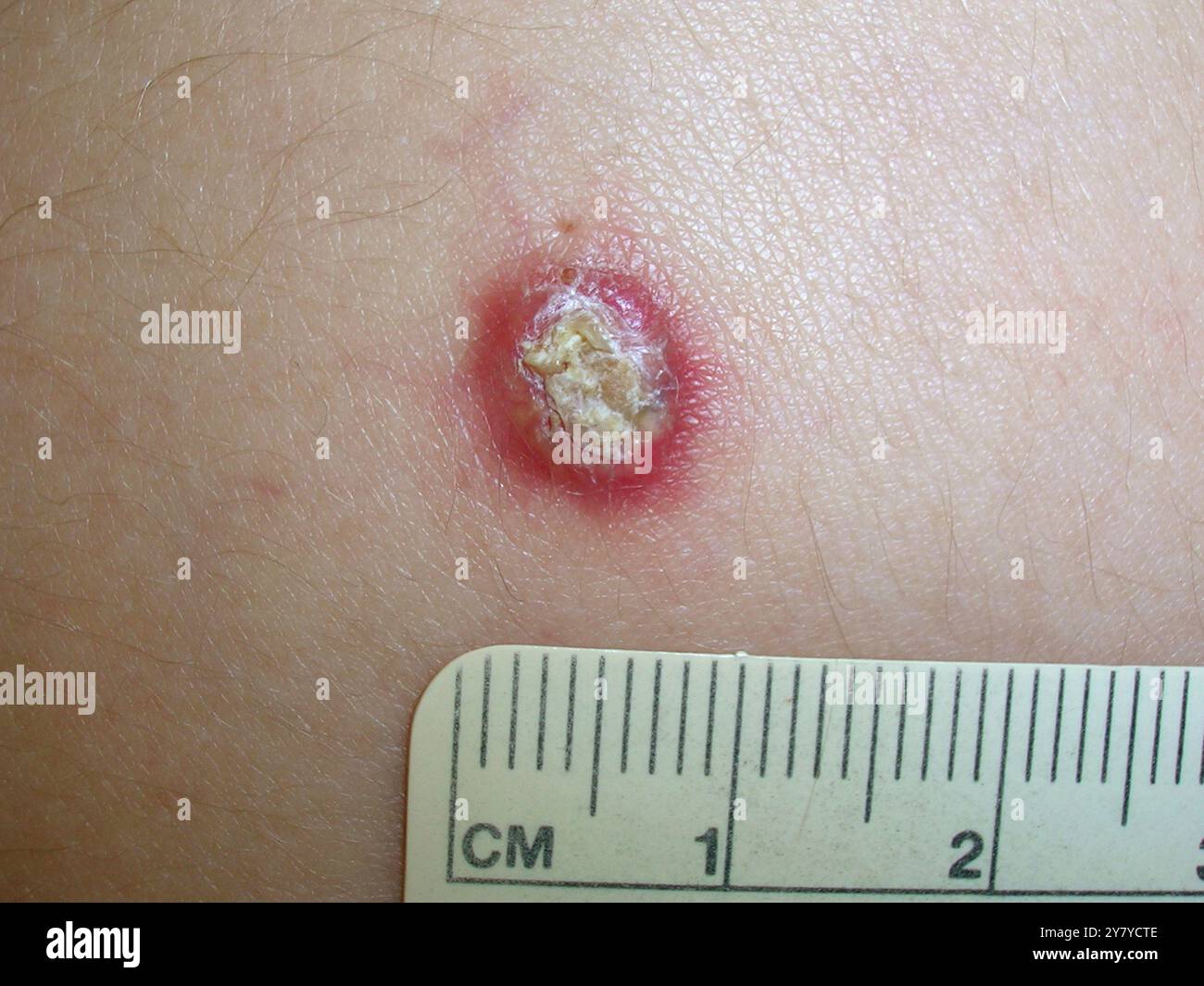 Pilomatricoma lesion on the back of an 8 year old Hispanic male patient ...