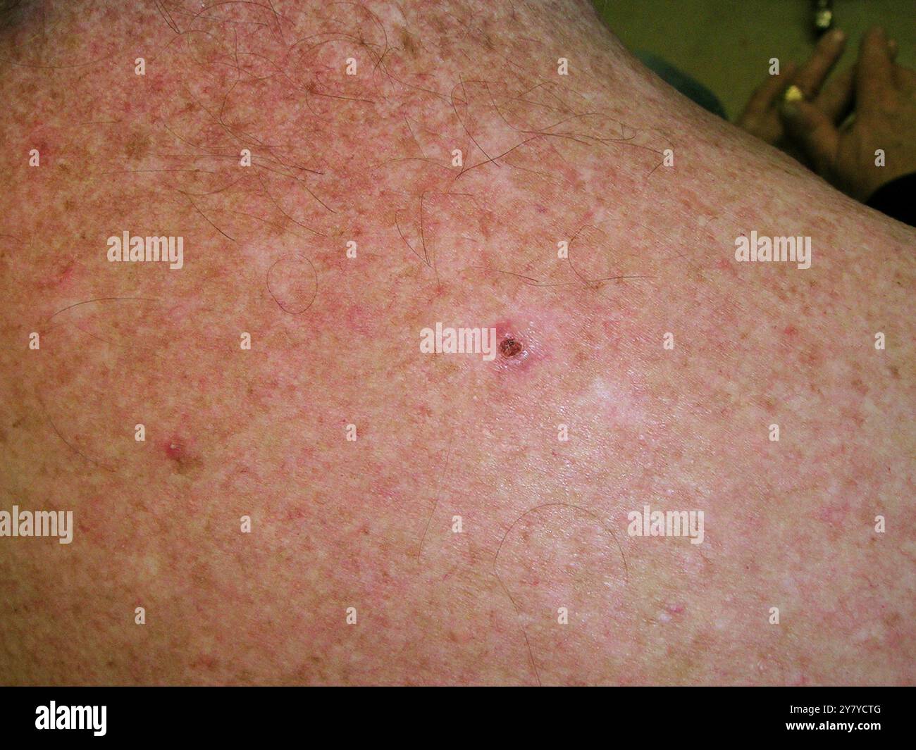 Nodular and micronodular basal cell carcinoma (BCC), or rodent ulcer ...