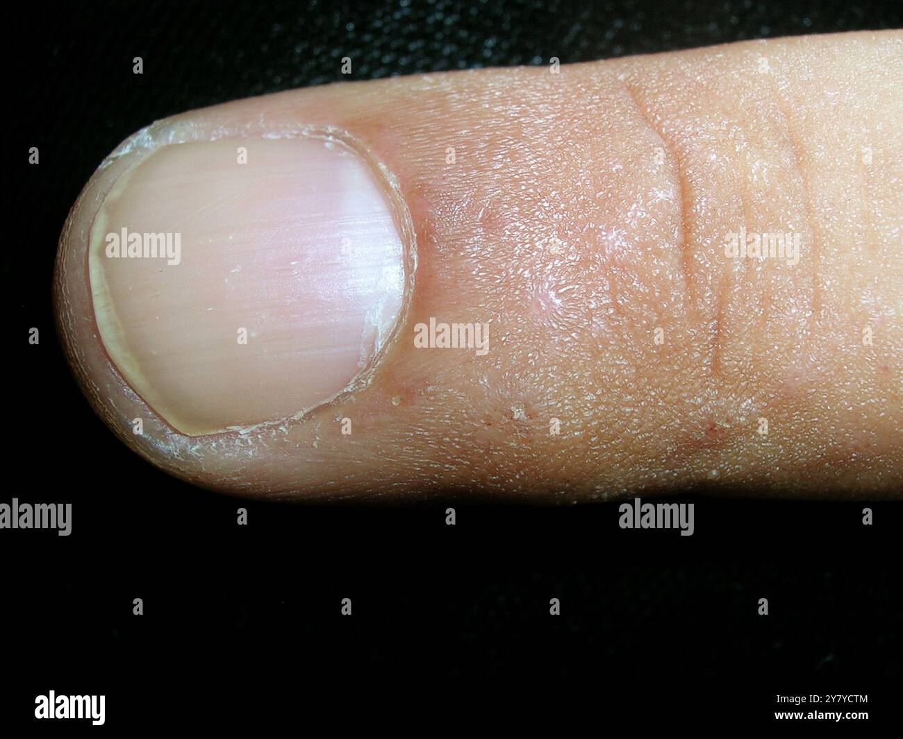 Id reaction on the finger of a Hispanic male patient with athlete's ...