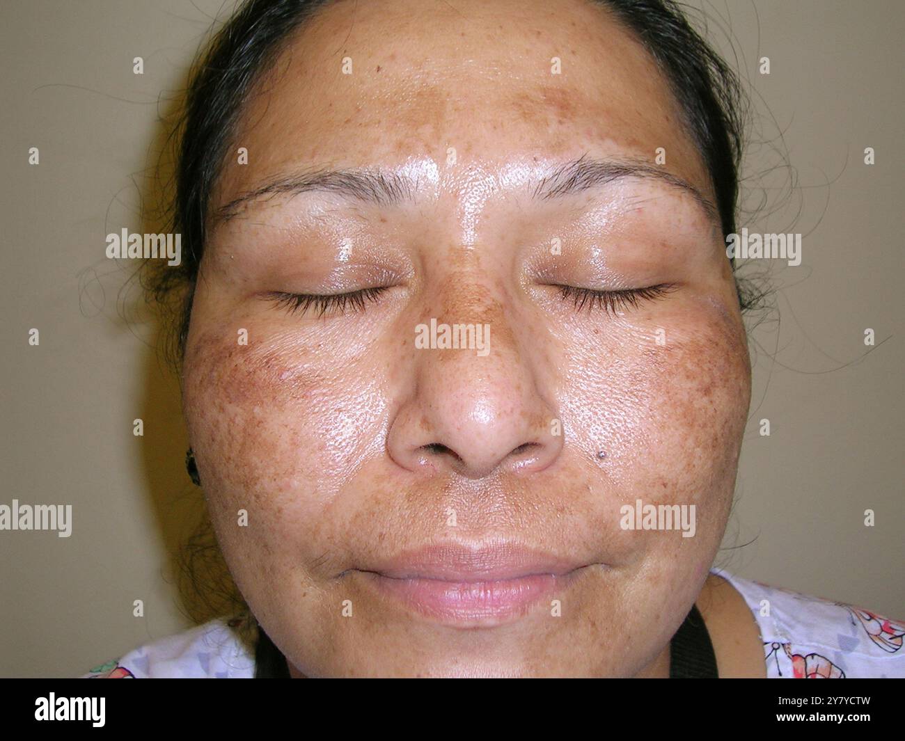Melasma on the face of a Hispanic female. Melasma, or chloasma, is ...