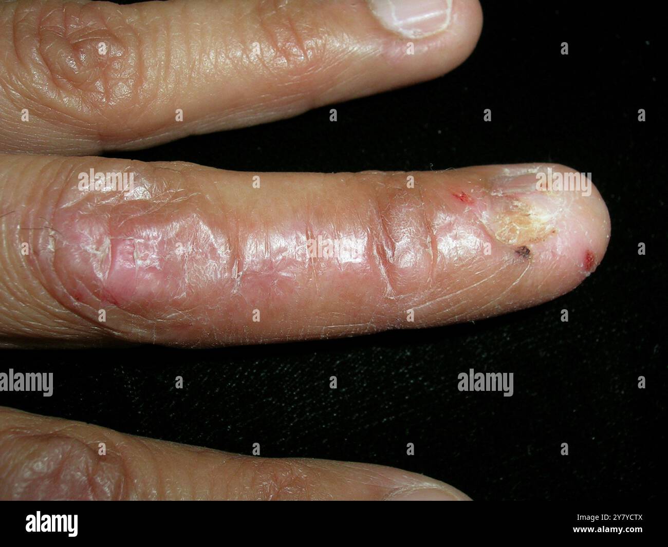 Linear lichen planus. Lichen planus is an inflammatory disorder of the ...
