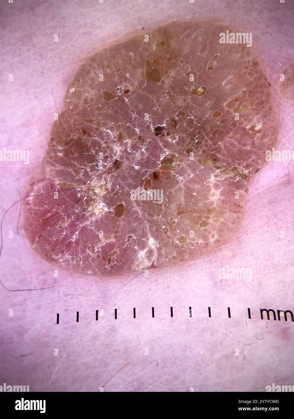 Dermatoscope image of a seborrheic keratosis with comedo-like openings ...