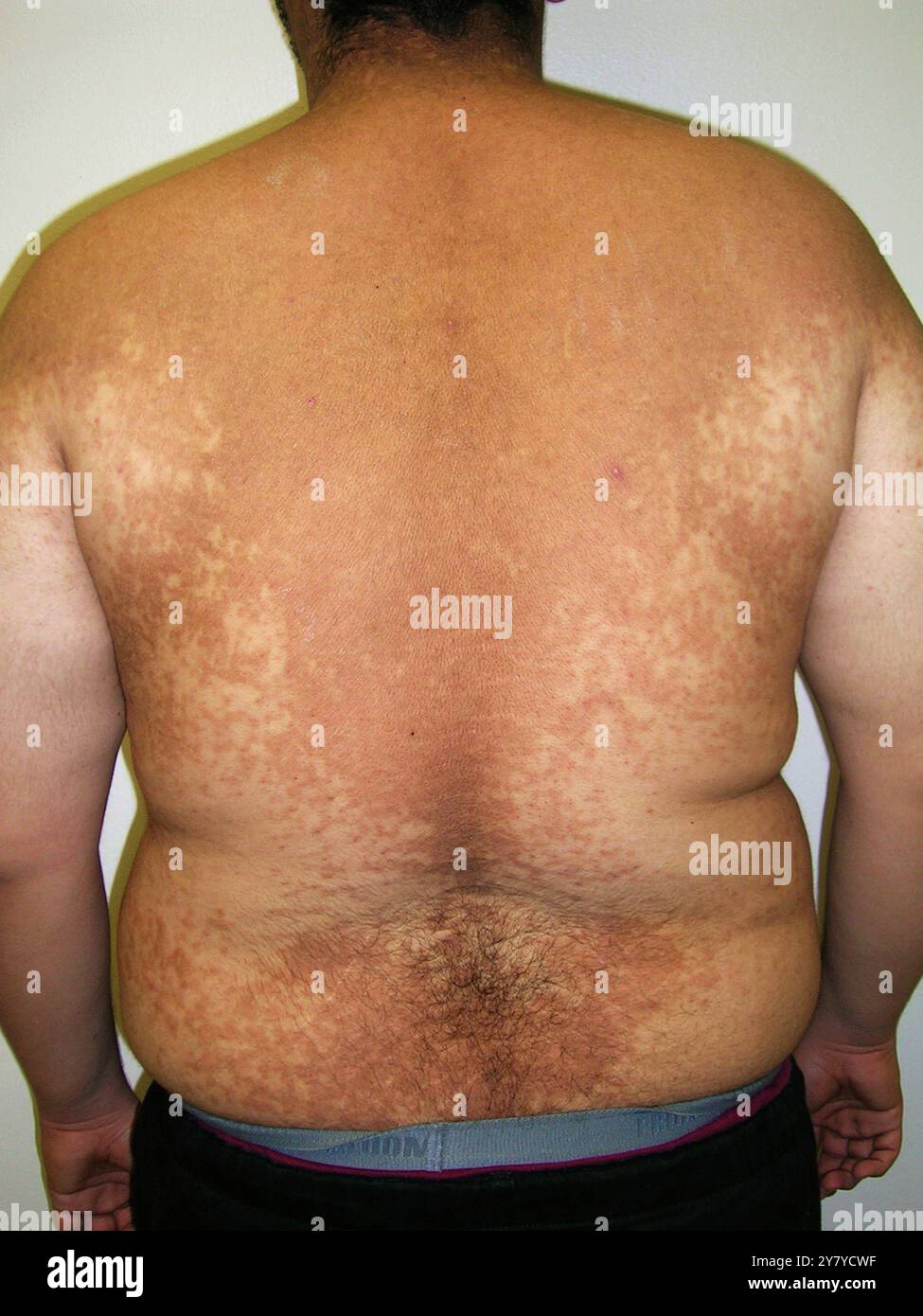 Confluent and reticulated papillomatosis on the back of a 16 year old ...