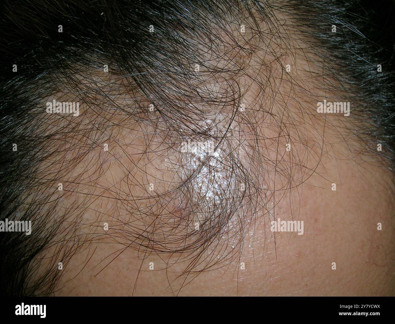 Hairline of a female patient with female pattern hair loss, also known ...