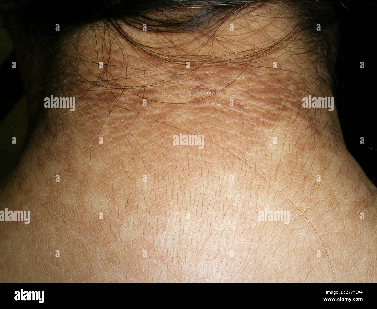 Confluent and reticulated papillomatosis on the back of a 16 year old ...