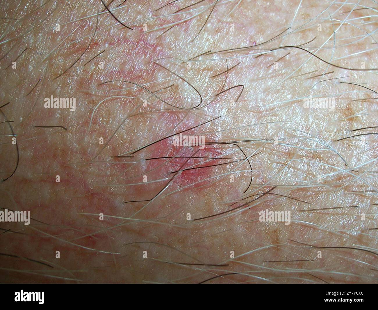 Micronodular basal cell carcinoma (BCC), or rodent ulcer, on the chest ...