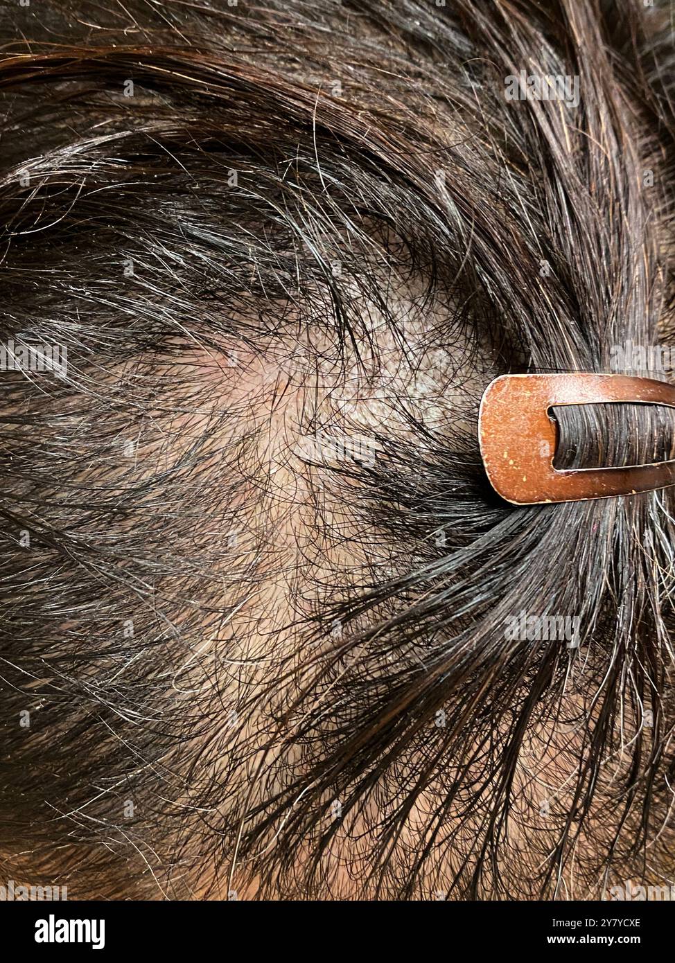 Scalp of a 35 year old Hispanic female patient with female pattern hair ...
