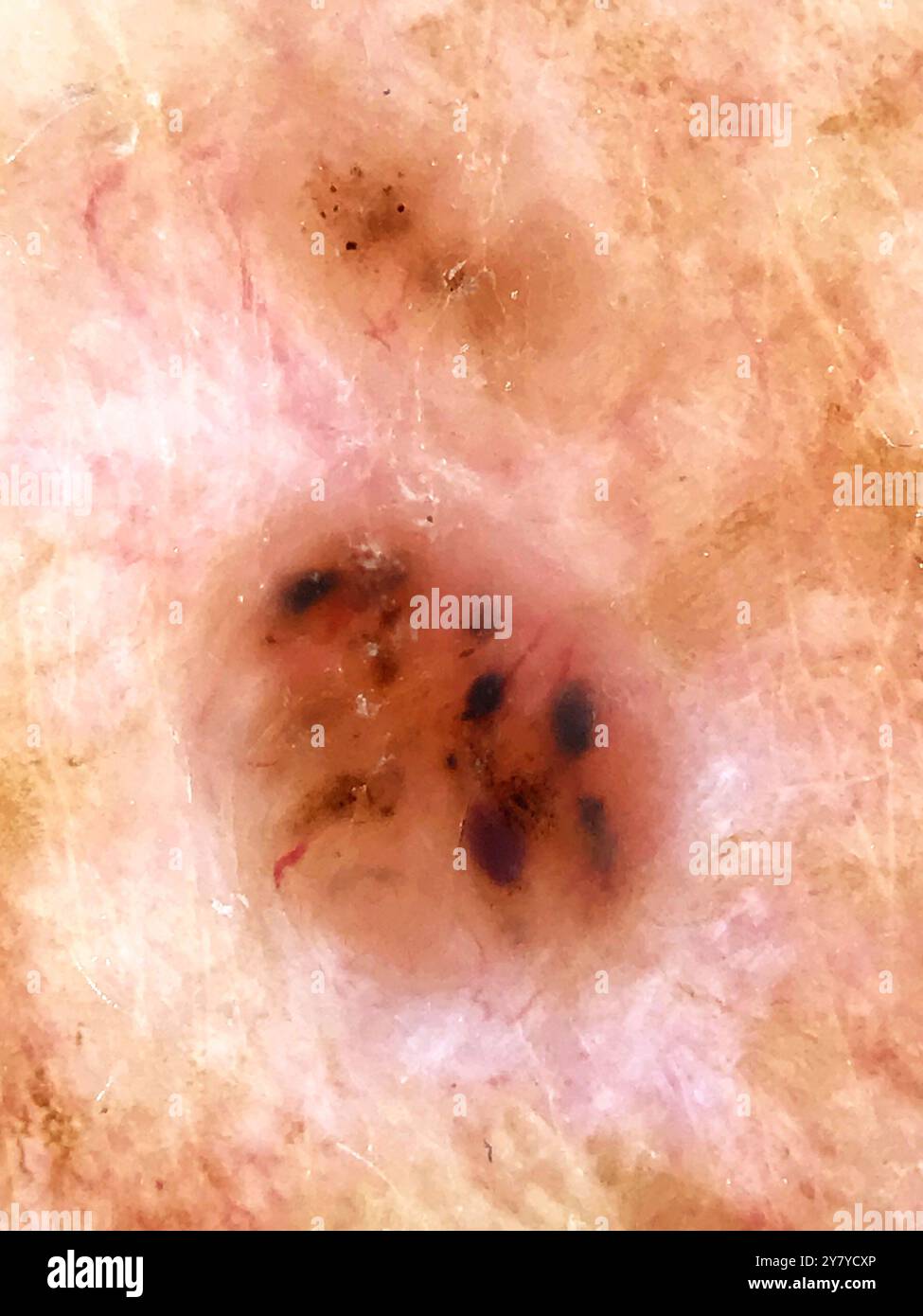 Dermatoscope image of a micronodular basal cell carcinoma (BCC), or ...