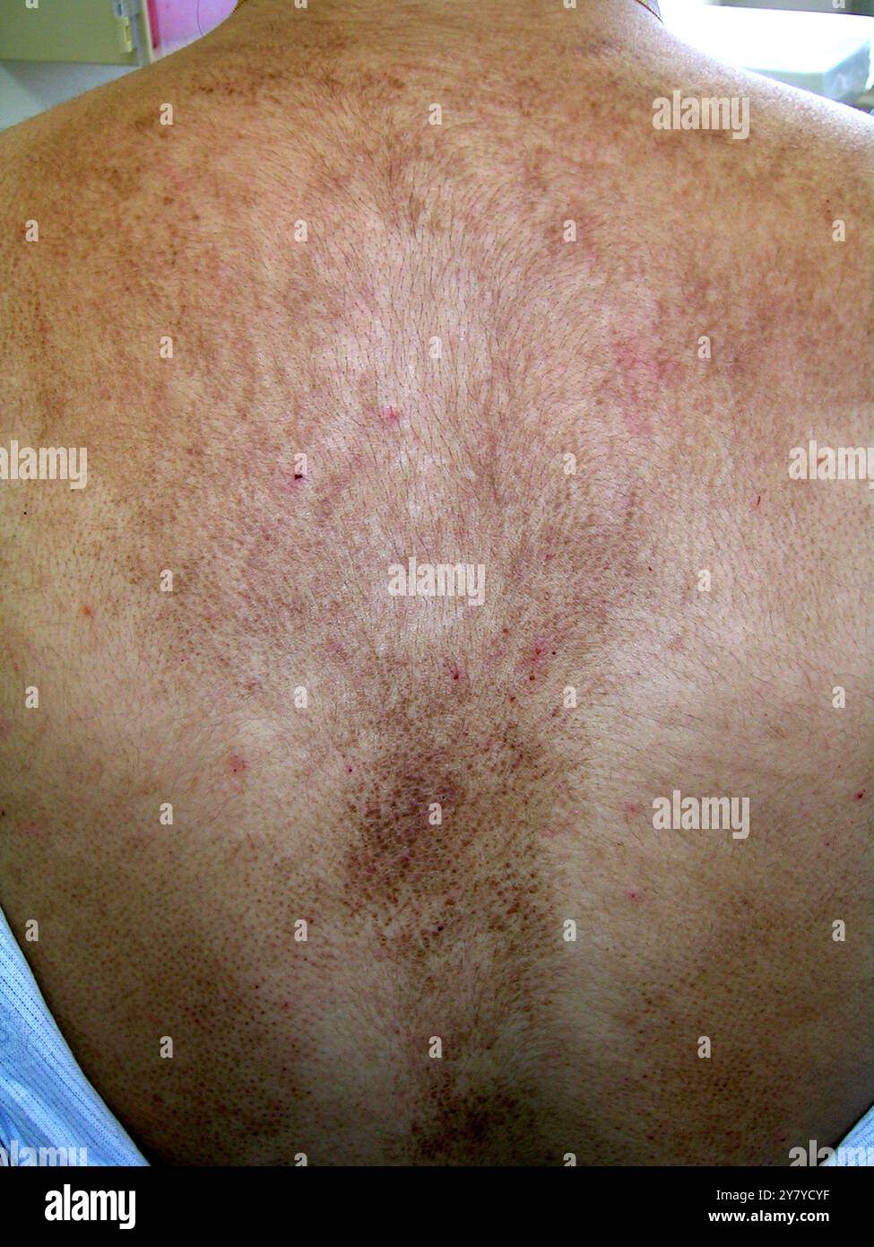 Confluent and reticulated papillomatosis on a patient's back. This rare ...