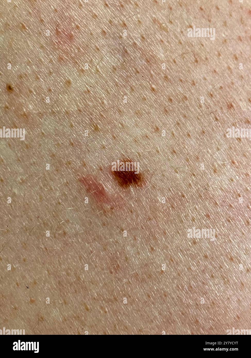 Mole on the back of a 26 year old white female patient. This skin mark ...