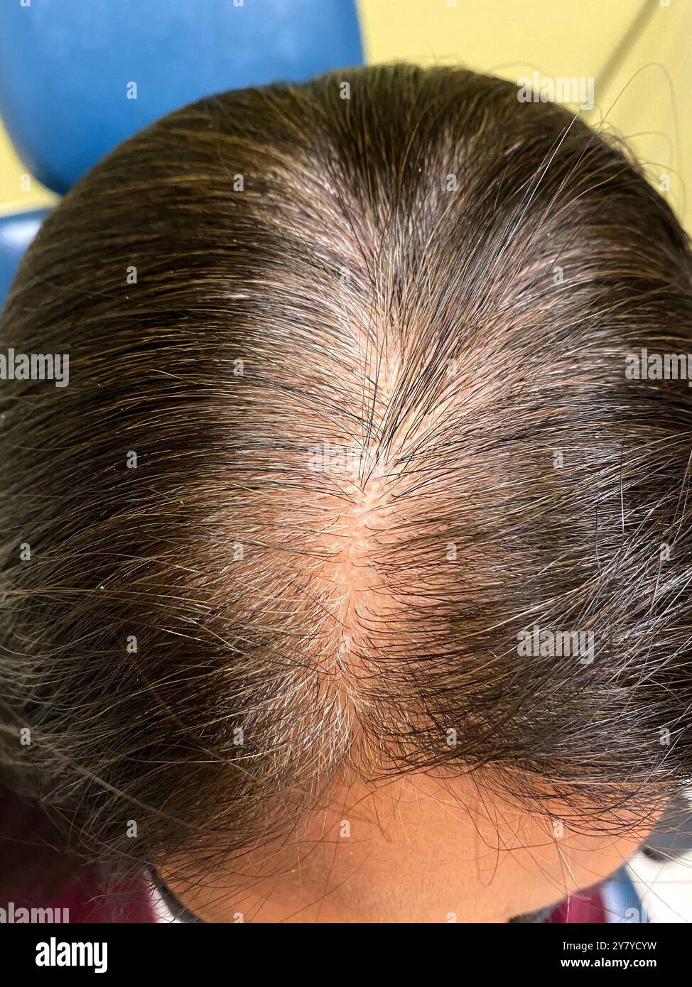 Scalp of a 63 year old Hispanic female patient with female pattern hair ...