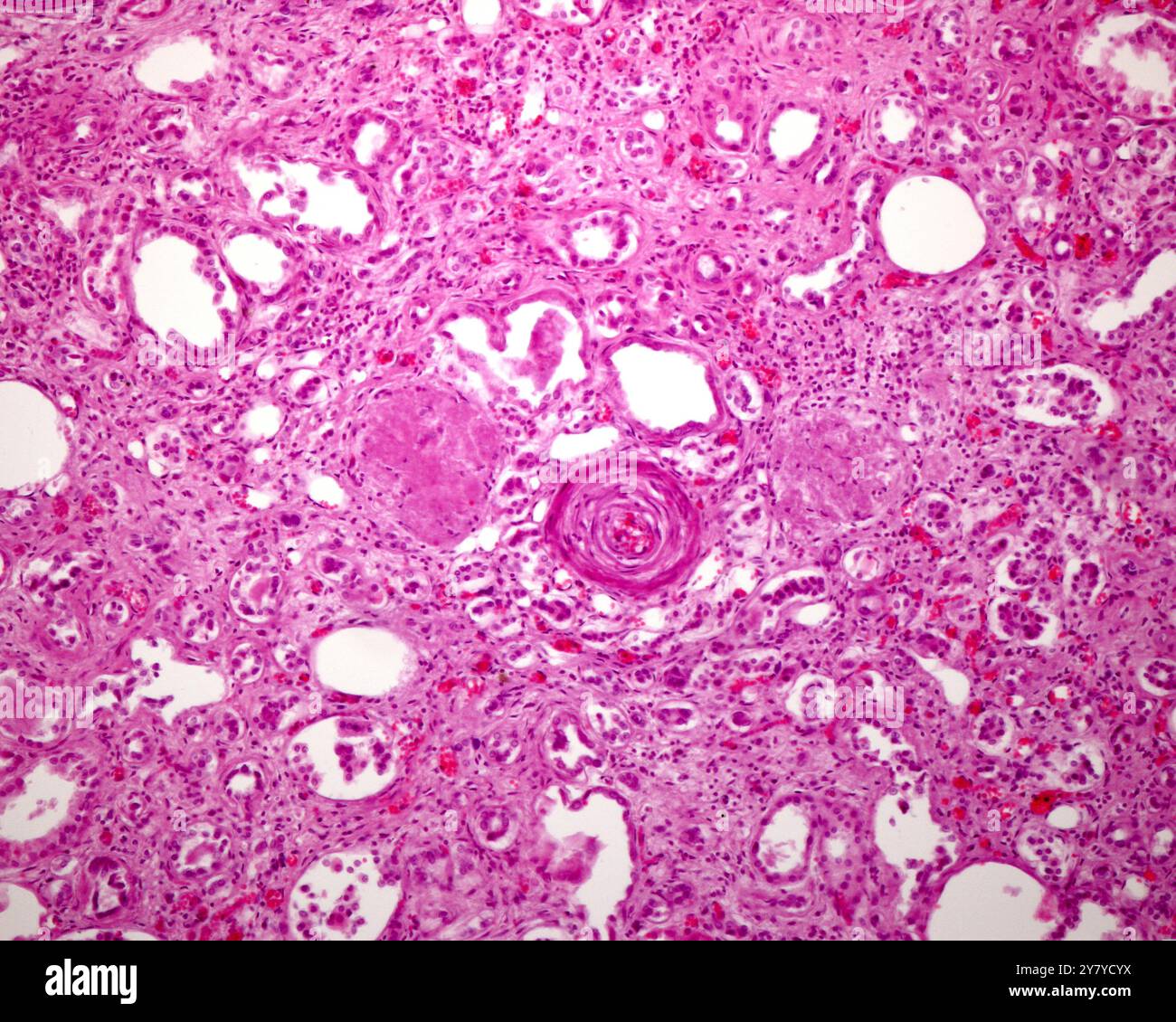 Nephrosclerosis in human kidney, light micrograph. Nephrosclerosis is a ...