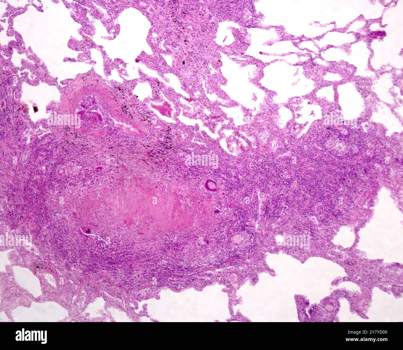 Light micrograph showing a human lung with a severe tuberculosis ...