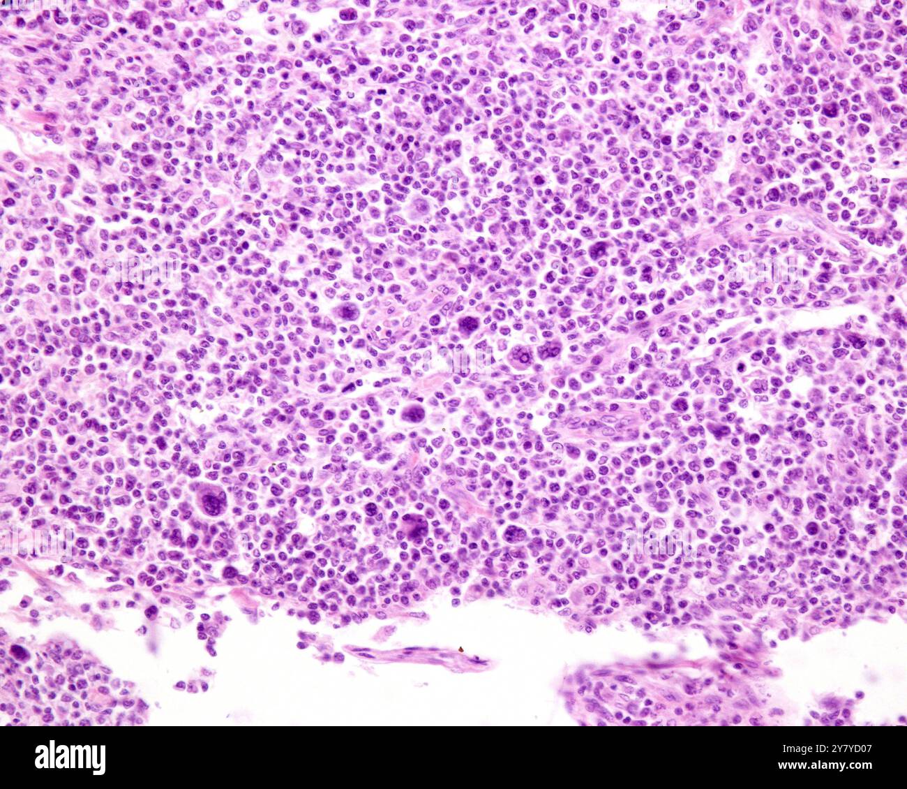Human lymph node in Hodgkin lymphoma, light micrograph. Hodgkin ...