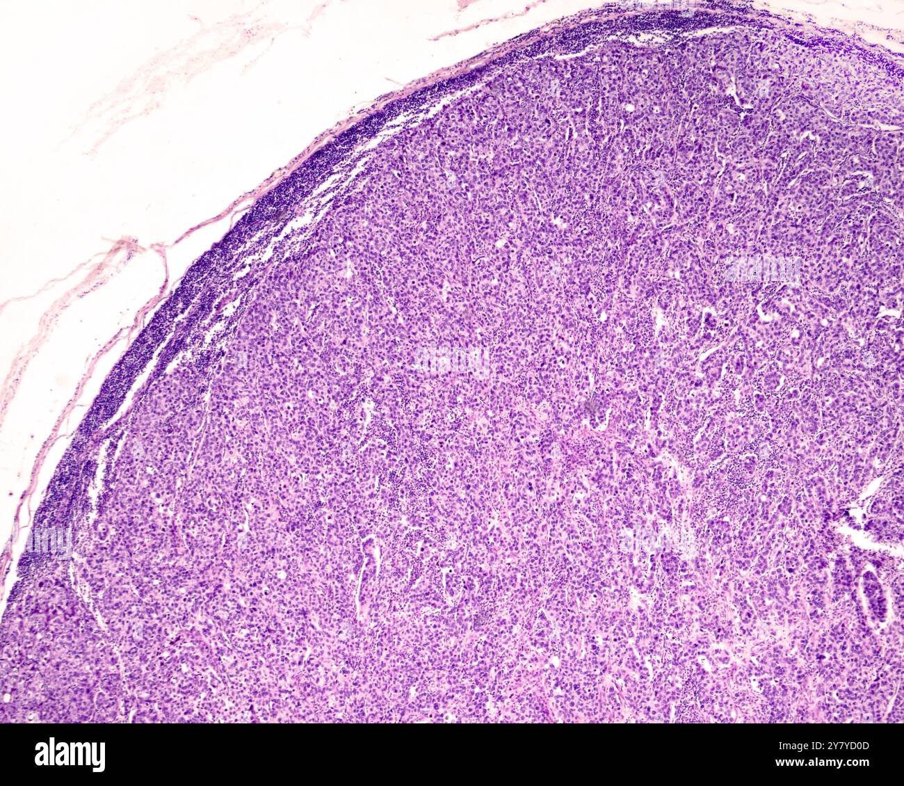 Light micrograph showing a human lymph node almost completely invaded ...