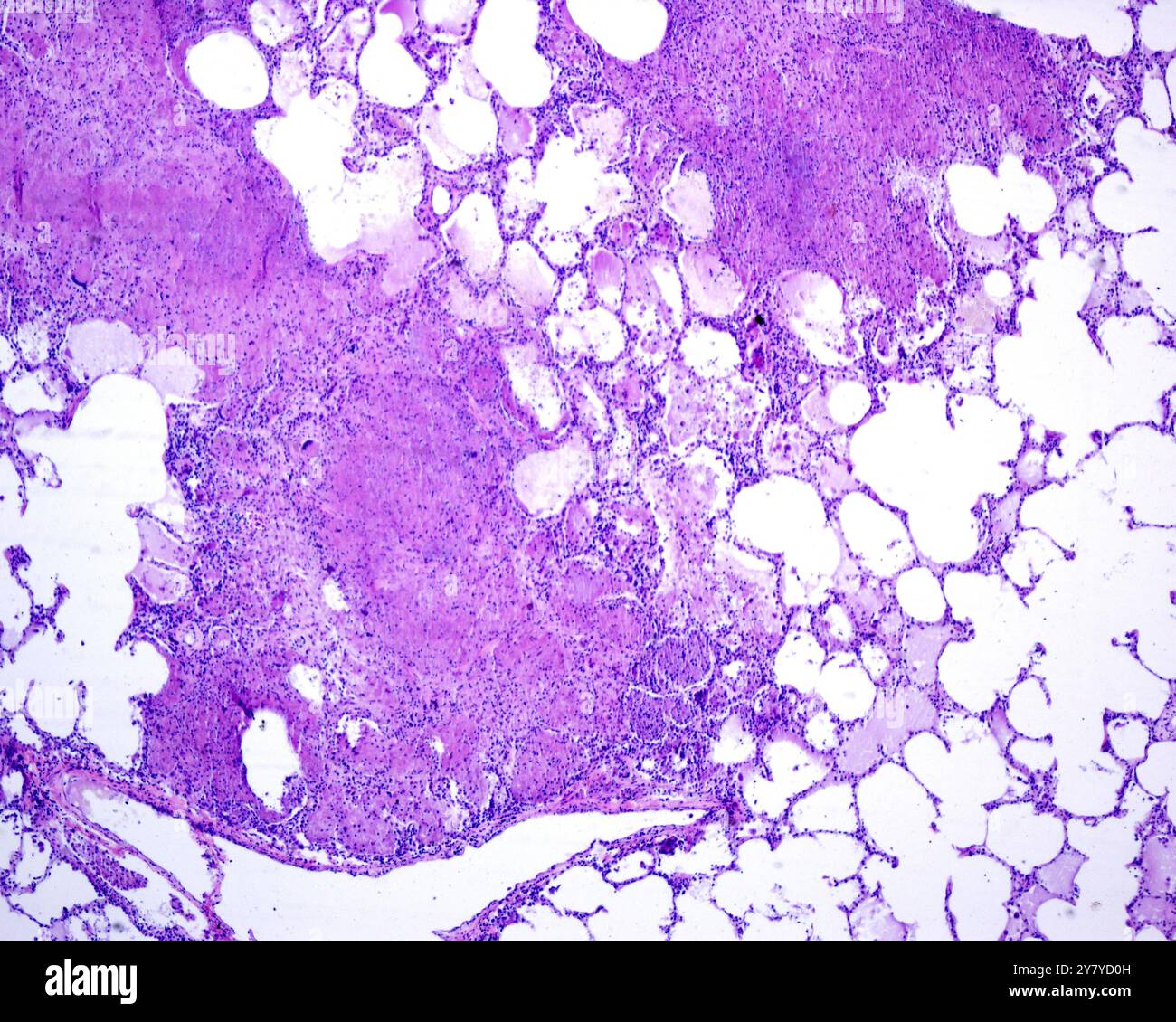 Light micrograph showing a human lung with a severe tuberculosis ...