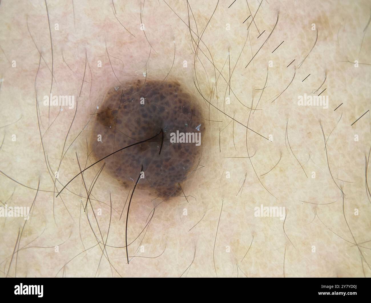Dermatoscope image of globules (round to oval structures) in a mole on ...