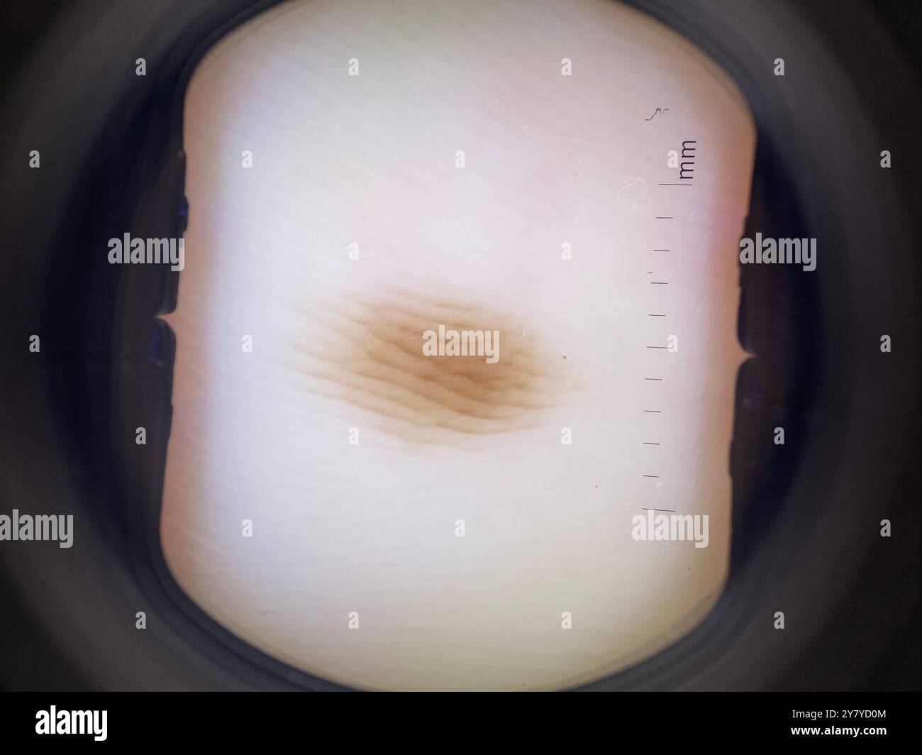 Dermatoscope image of a mole showing the parallel furrow pattern, where ...