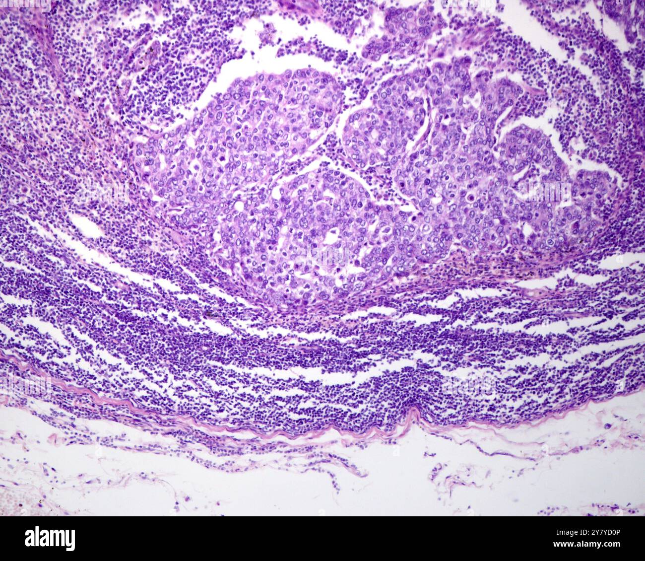 Light micrograph showing a human lymph node almost completely invaded ...