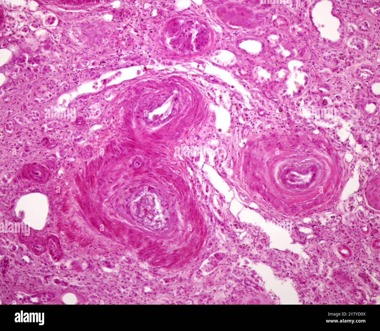 Nephrosclerosis in human kidney, light micrograph. Nephrosclerosis is a ...
