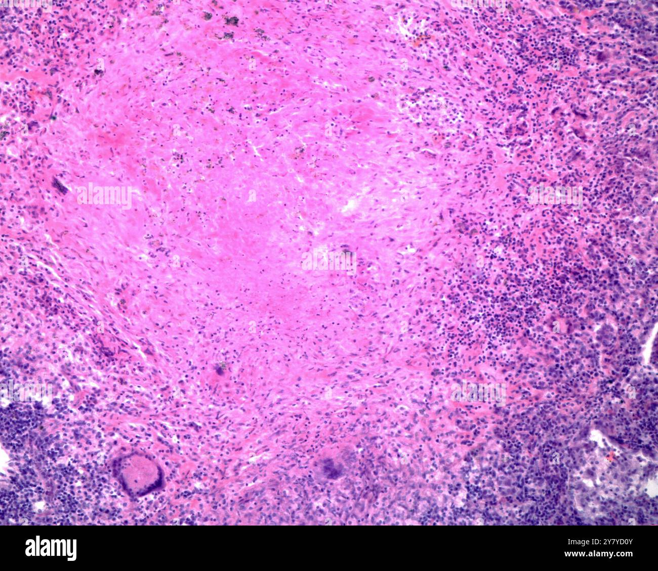 Light micrograph showing a human lung with a severe tuberculosis ...