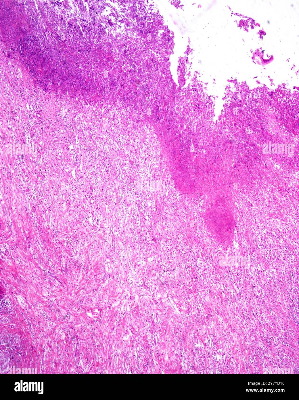 Light micrograph showing a human gastric ulcer. The ulcer has destroyed ...