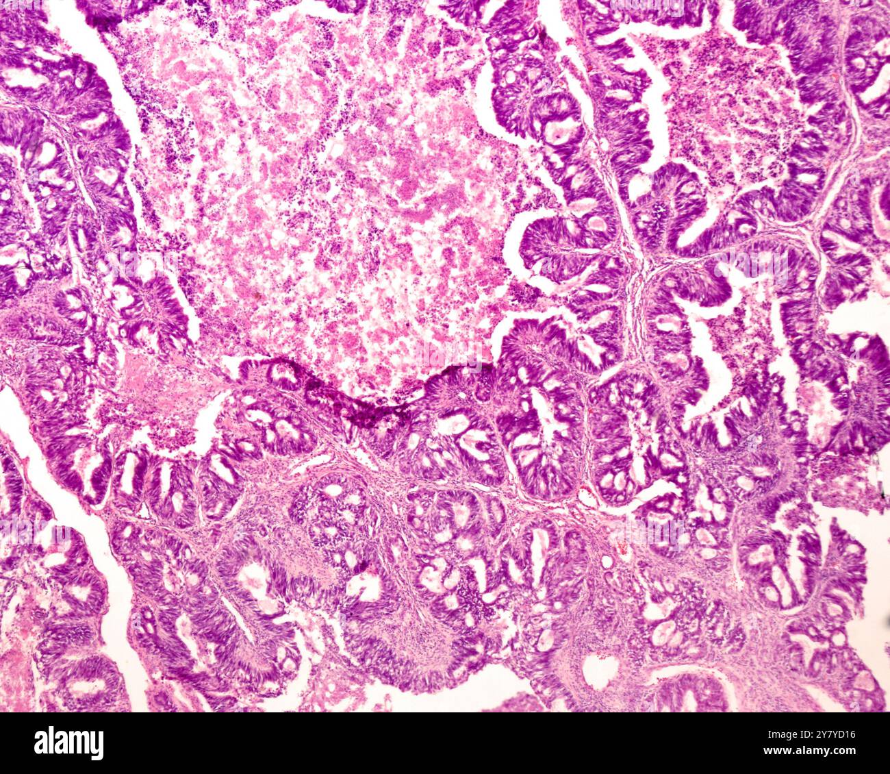 Light micrograph showing a human lymph node completely invaded by ...