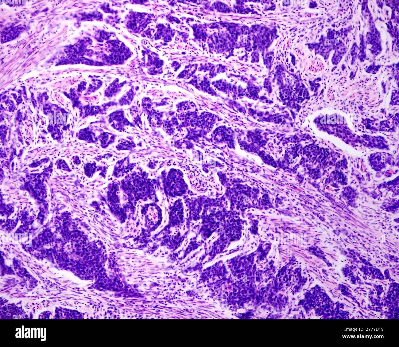 Light micrograph of a small cell carcinoma infiltrating the myometrium ...