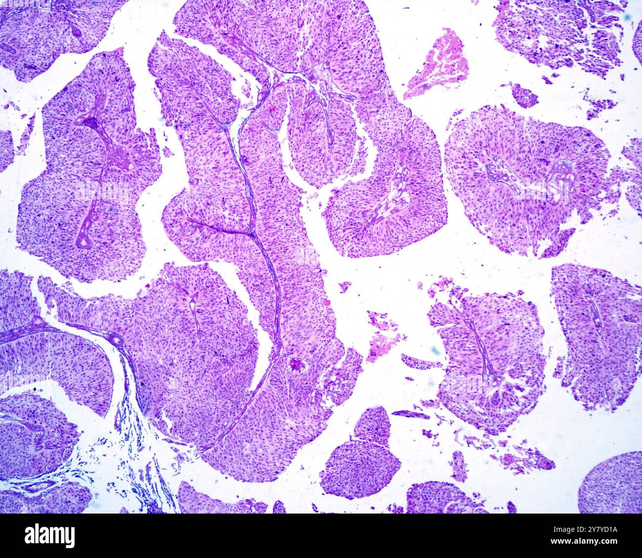 Light micrograph of a urinary bladder papilloma formed by papillae with ...
