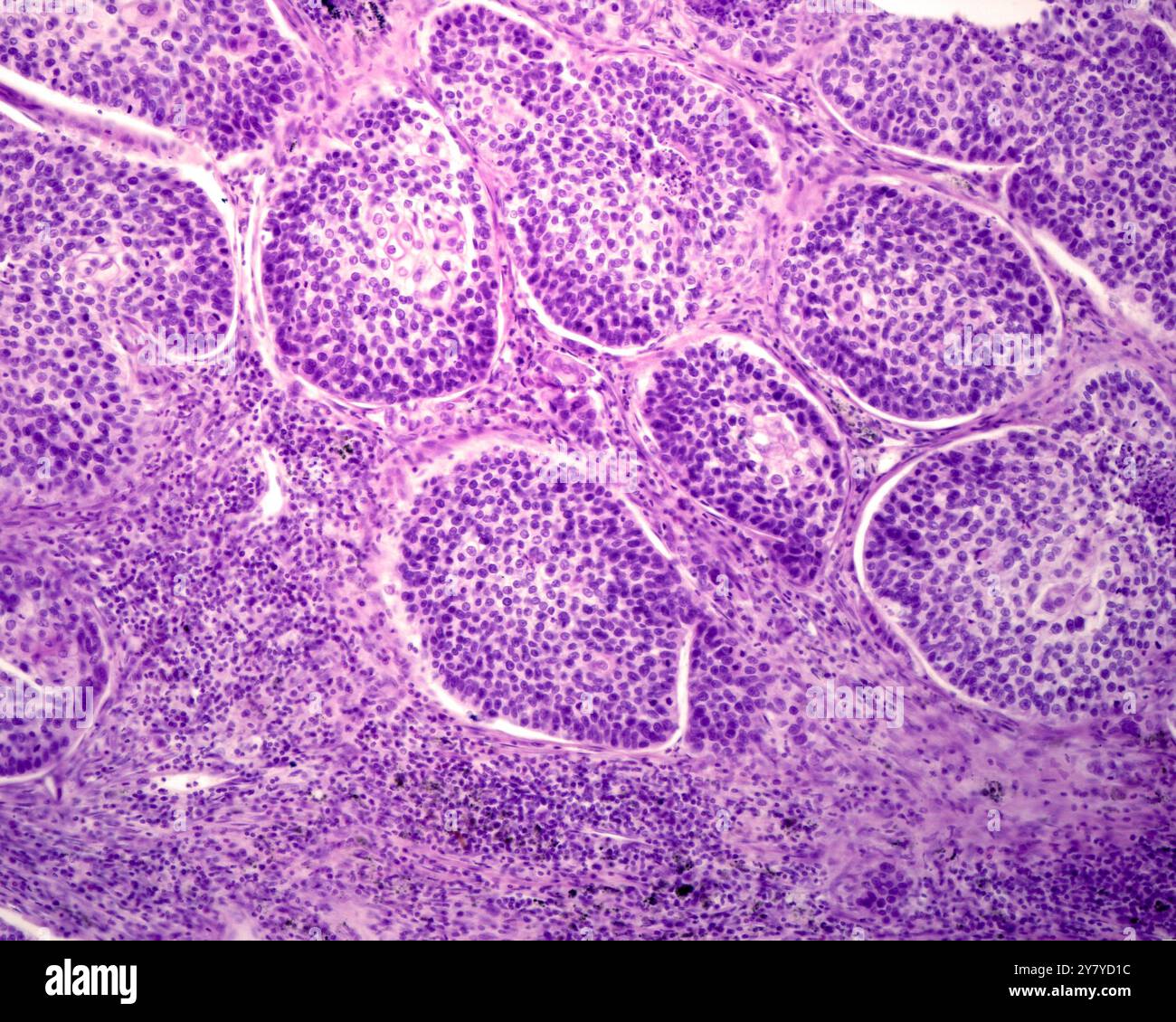 Light micrograph of a poorly differentiated squamous cell carcinoma of ...