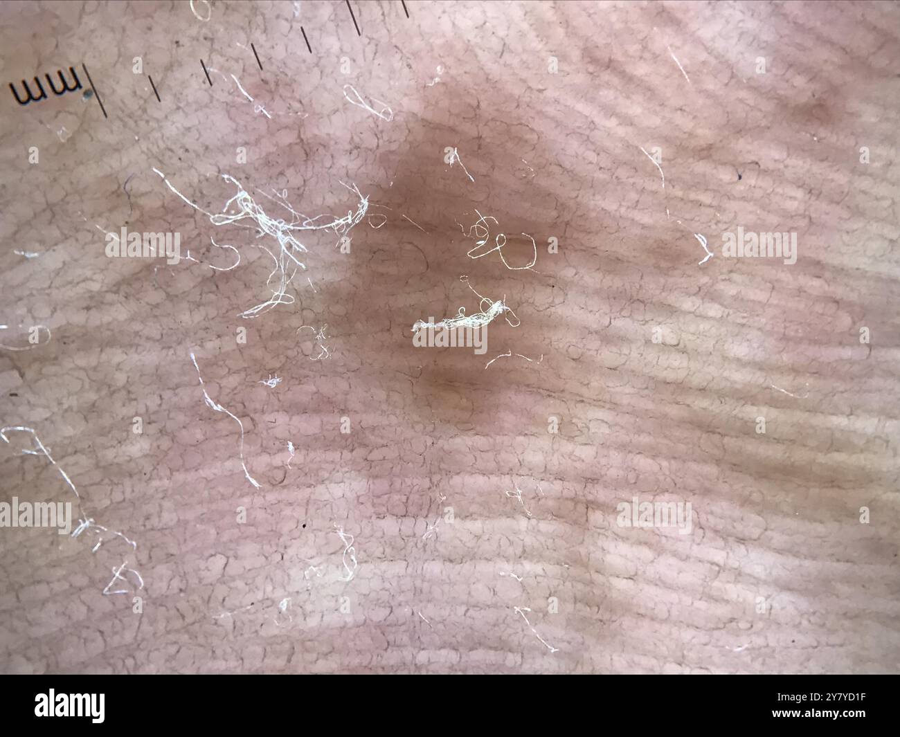 Dermatoscope image of a mole on the skin of an Africa-American male ...