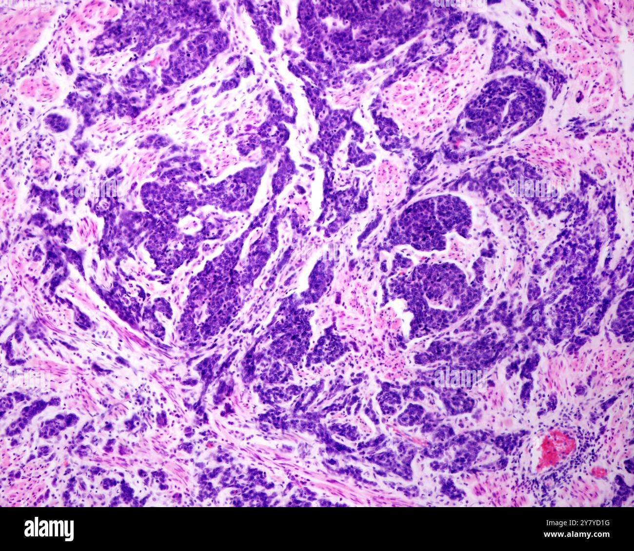 Light micrograph of a small cell carcinoma infiltrating the myometrium ...