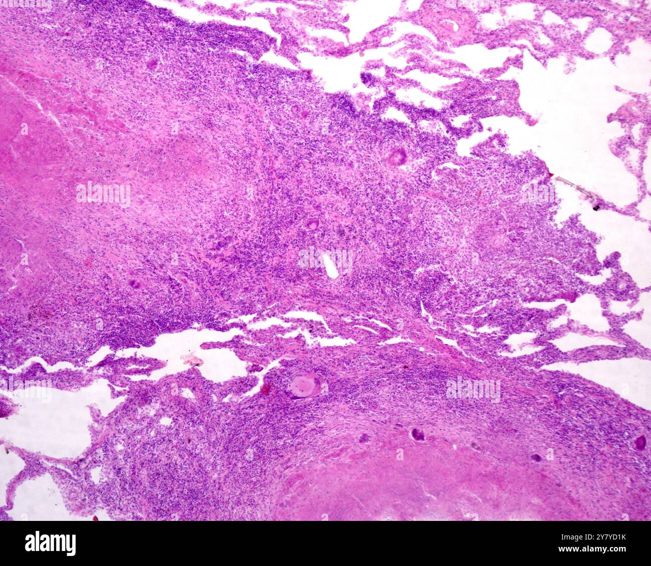 Light micrograph showing a human lung with a severe tuberculosis ...