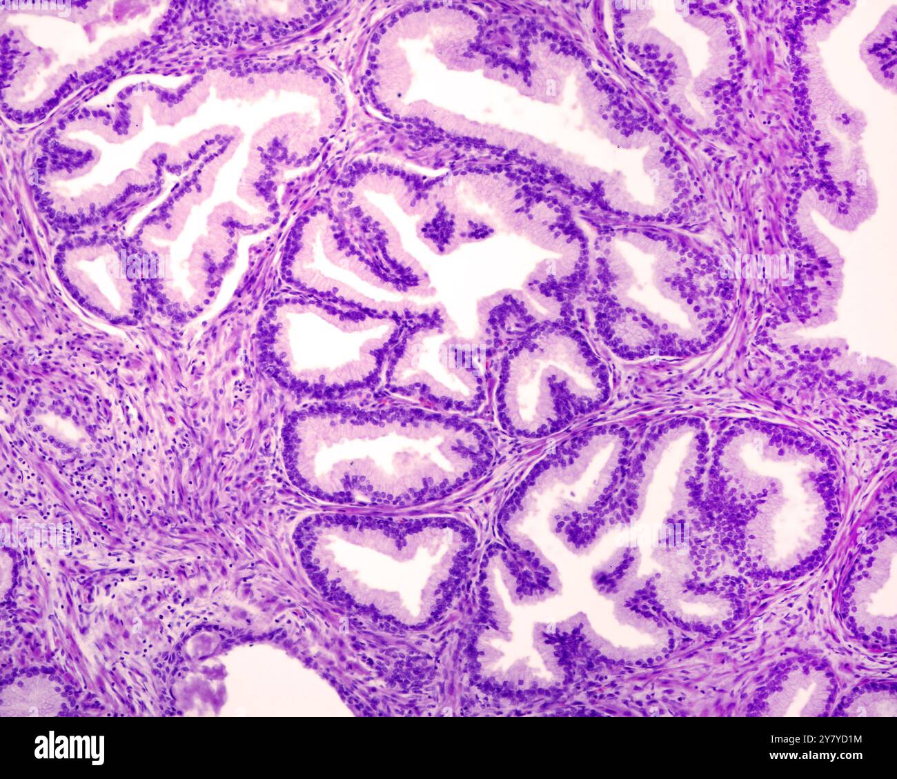 Light micrograph showing a prostate gland lined by a simple columnar ...