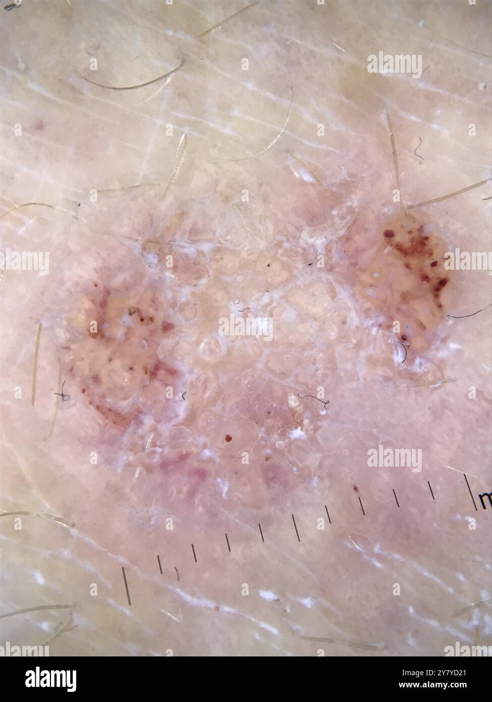 Squamous cell carcinoma, dermoscopy Stock Photo - Alamy
