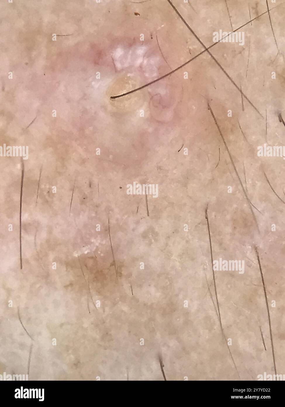 Dermatoscope image of crown vessels around papules on the skin of a ...