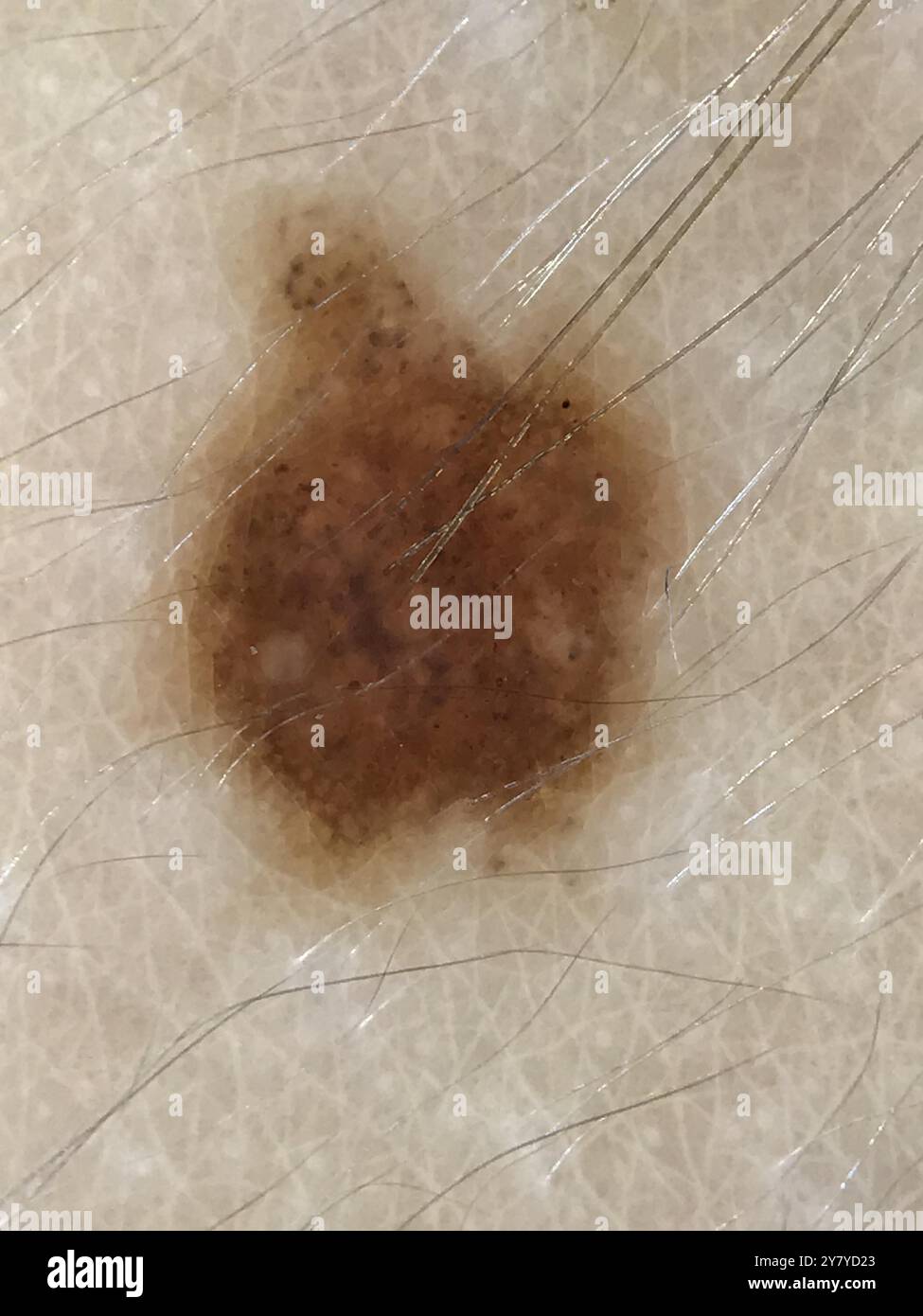 Dermatoscope image of globules (round to oval structures) in a mole on ...