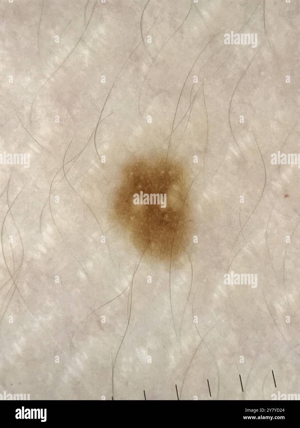 Dermatoscope image of globules (round to oval structures) in a mole on ...