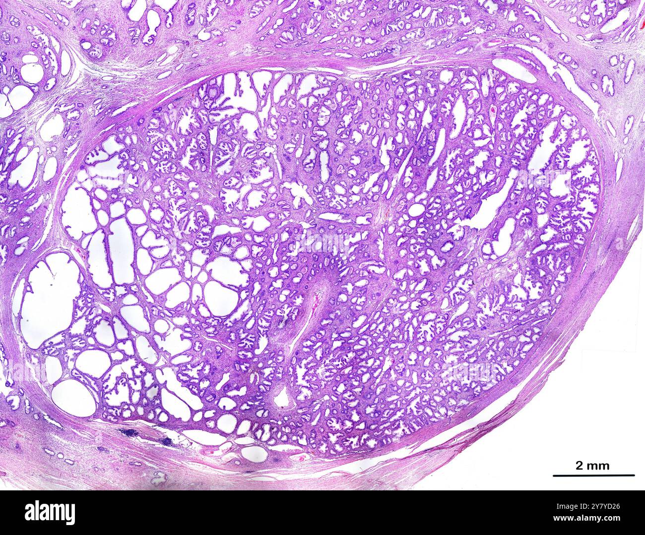 Light micrograph showing a large hyperplastic nodule in a case of ...