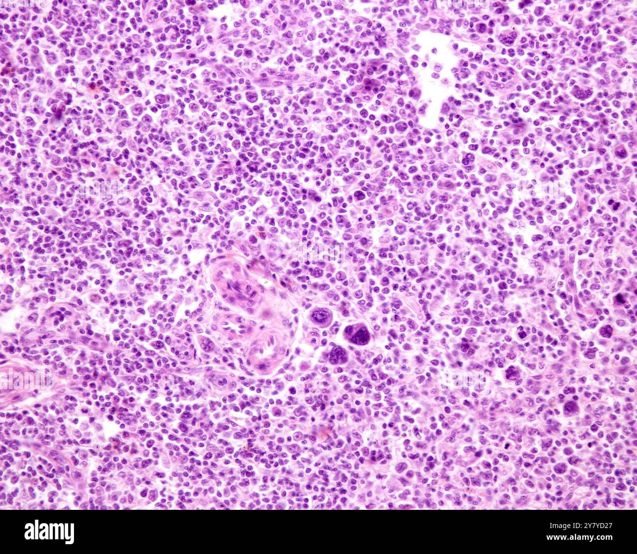 Human lymph node in Hodgkin lymphoma, light micrograph. Hodgkin ...
