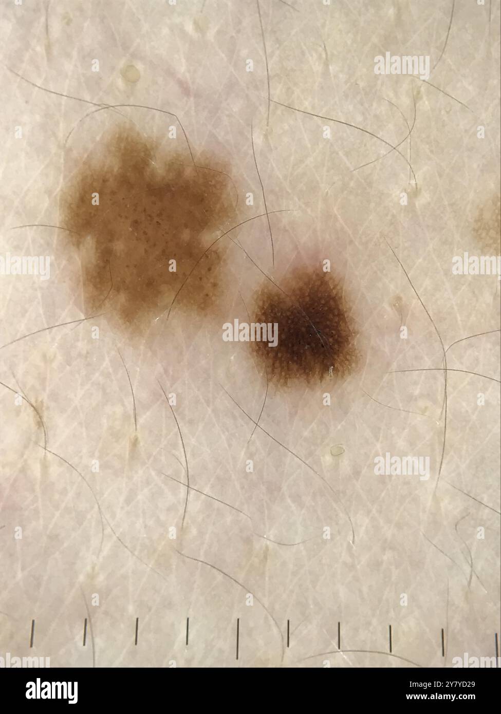 Dermatoscope image of a mole on the skin of a 27 year old patient. This ...