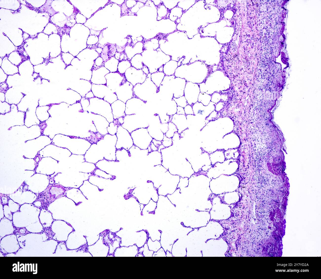 Human lung. Light micrograph showing a human lung with dilated alveoli ...