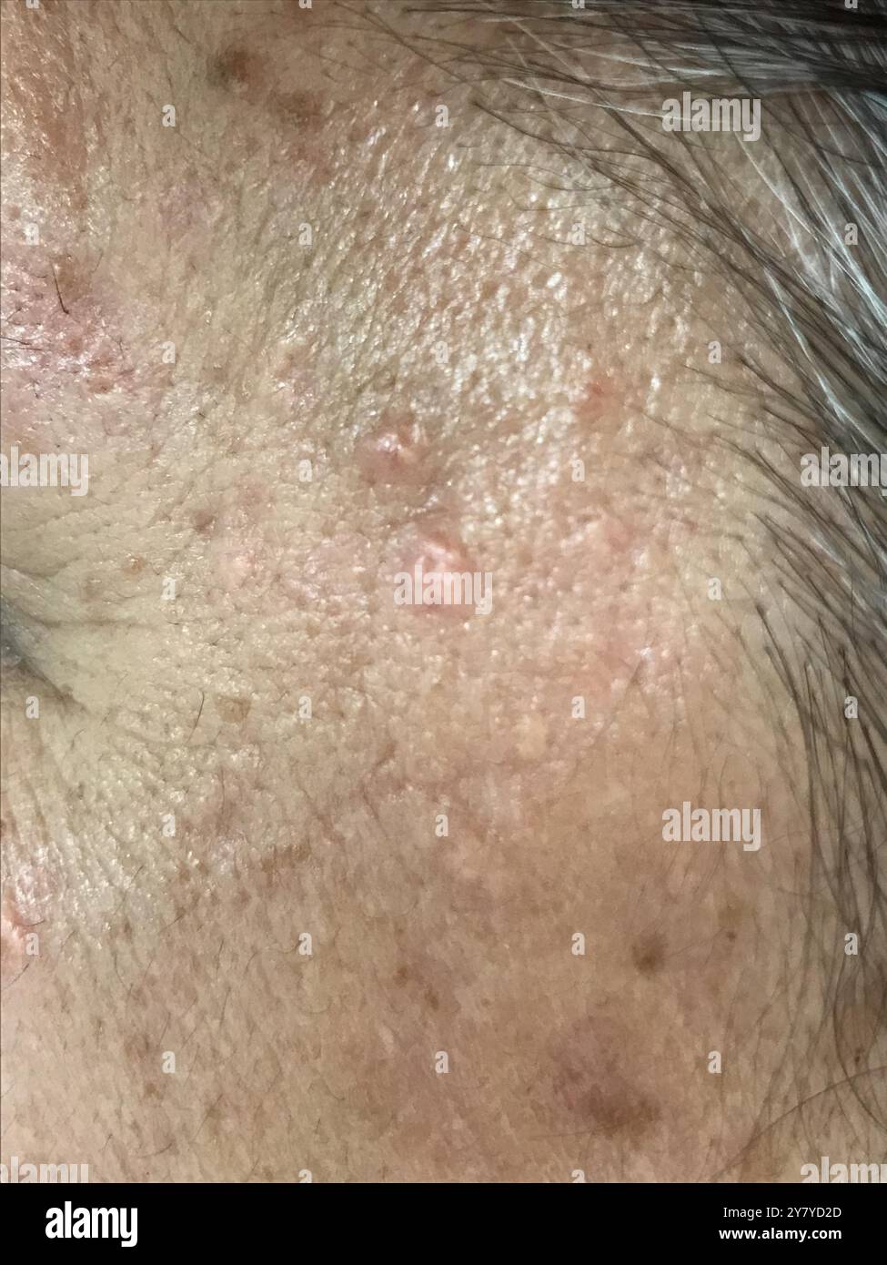 Sebaceous hyperplasia on a patient's temple. This is the harmless ...