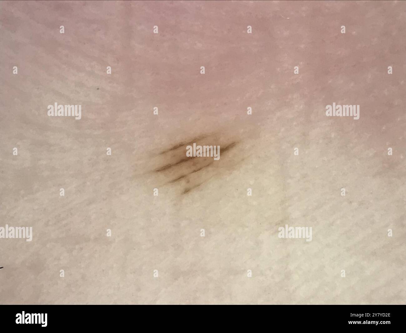 Dermatoscope image of a mole showing the parallel furrow pattern, where ...
