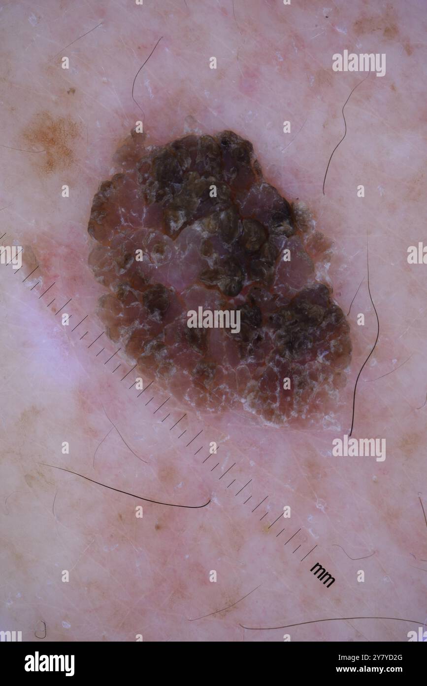 Dermatoscope image of a cerebriform seborrheic keratosis. This skin ...