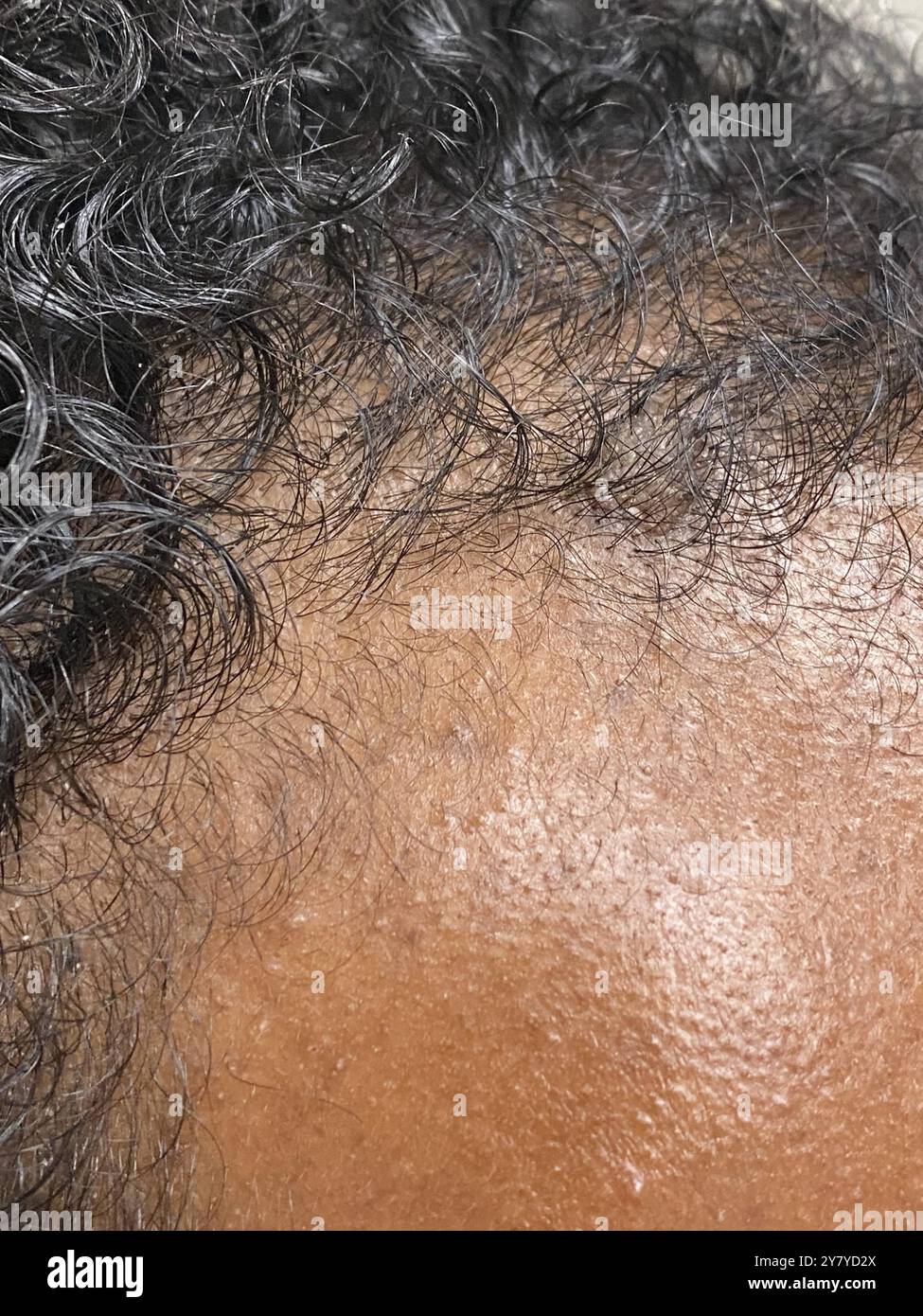 Hairline of an Africa-American female patient with female pattern hair ...
